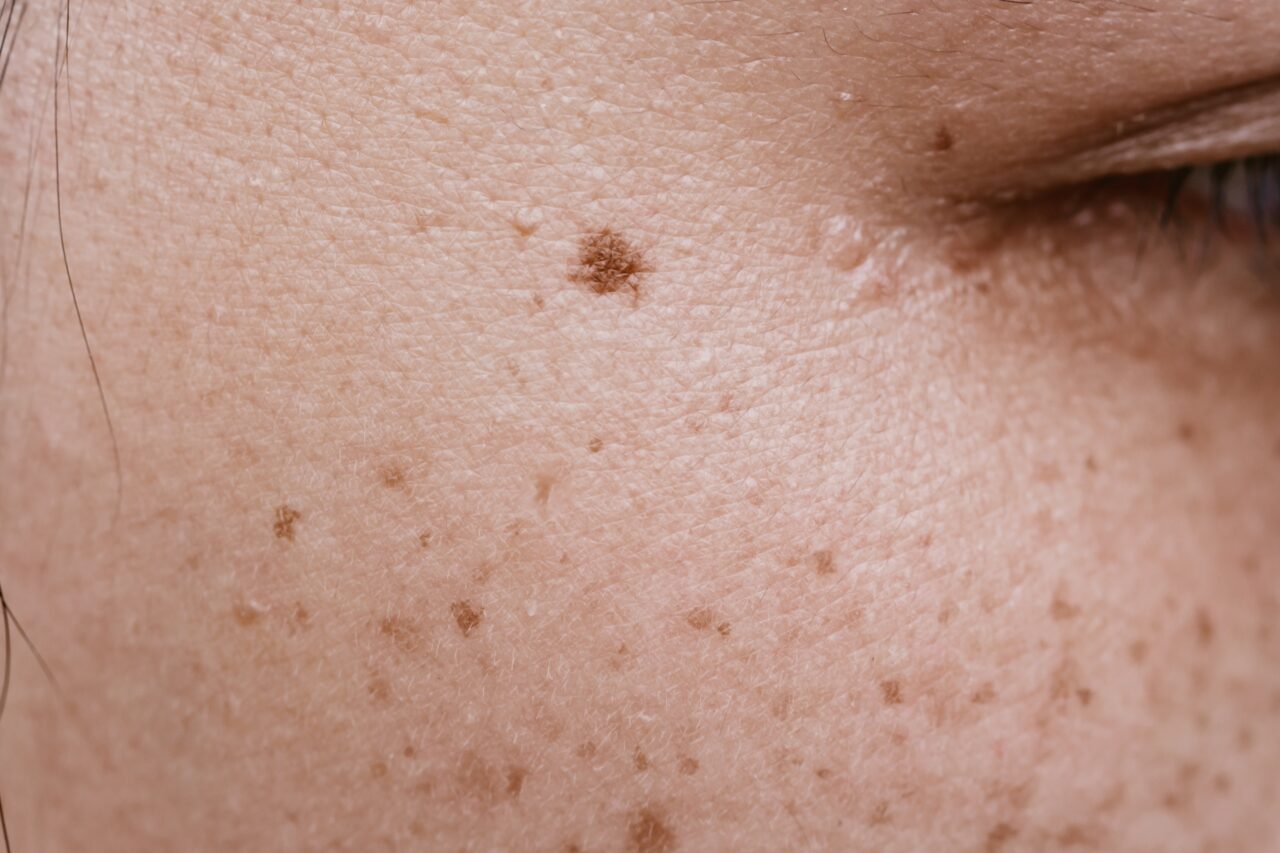 IPL Pigmentation - SkinGenius Clinic